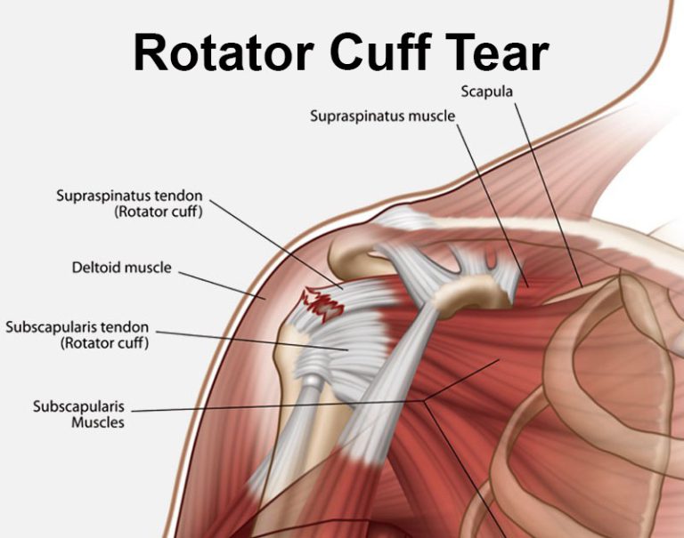 Rotator Cuff Tear: How To Avoid Surgery With Regenerative Medicine ...