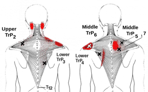 Trigger Point Injection Therapy - OPDAHL Regenerative Medicine