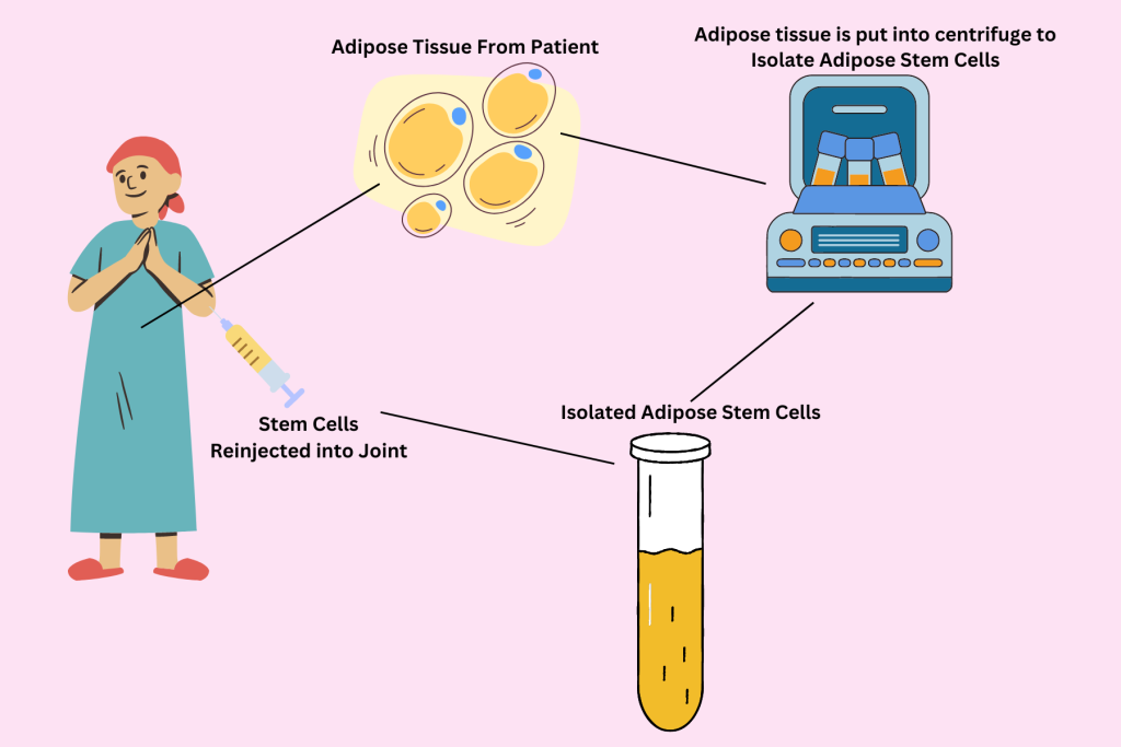 MFAT Therapy: Micro-Fragmented Adipose Tissue - OPDAHL Regenerative ...